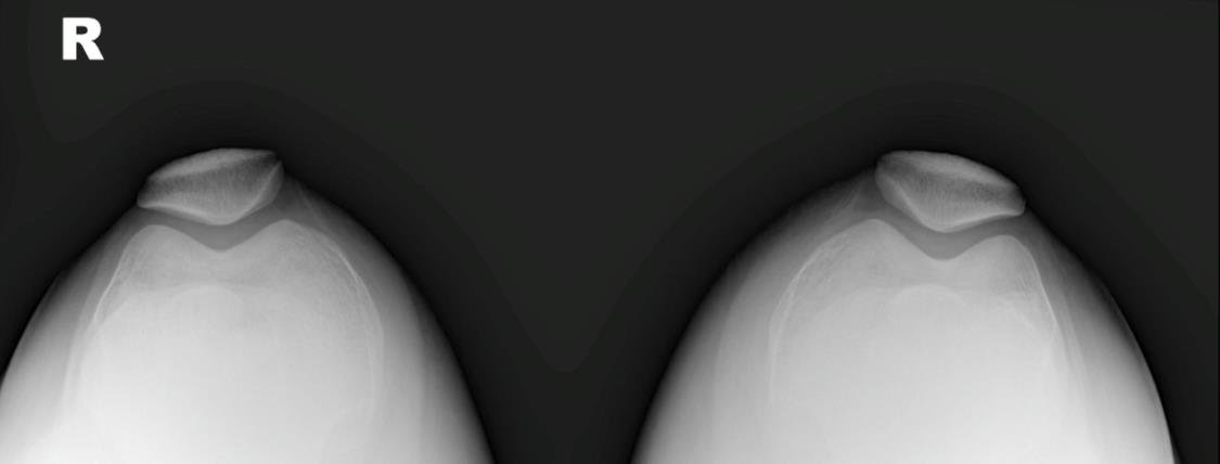 La Radiografía De Rodilla: Una Ventana Esencial A La Salud Articular